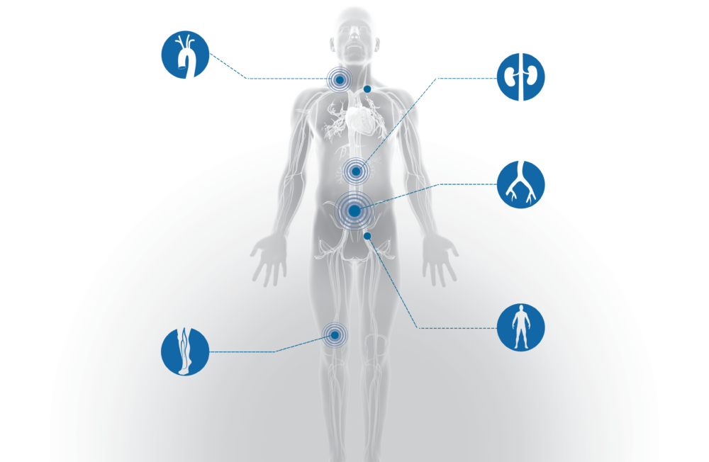 Passport® Steerable Sheath | Cannulate Contralateral Access | Renal ...