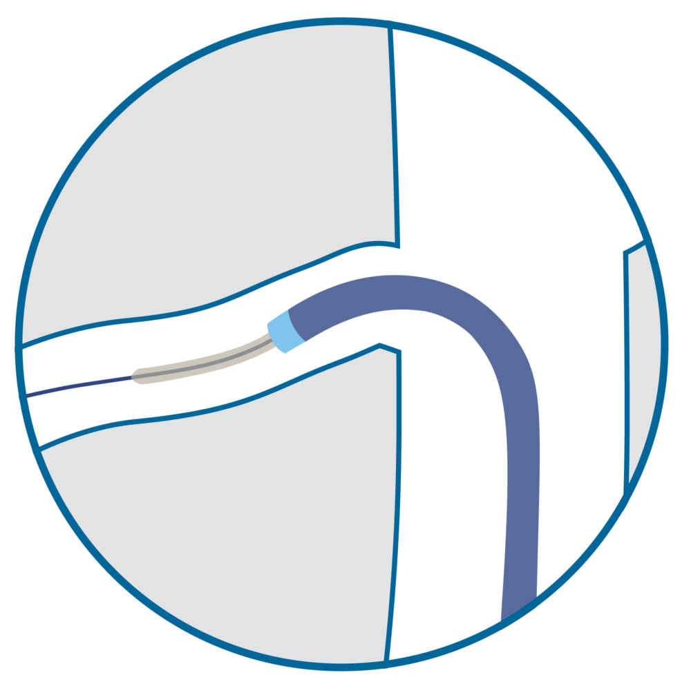 Passport® Steerable Sheath | Cannulate Contralateral Access | Renal ...