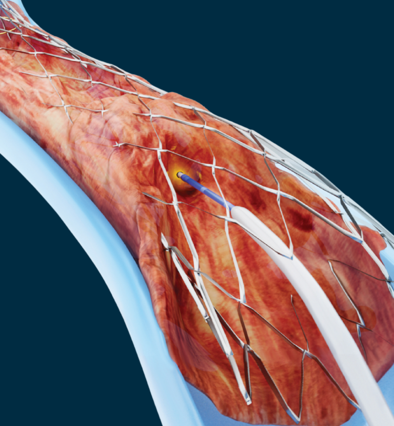 Baylis Medical Technologies Launches PowerWire® Pro RF Guidewire