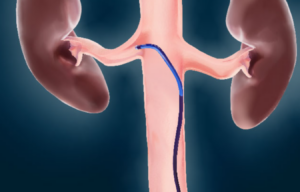 Passport® Steerable Sheath | Cannulate Contralateral Access | Renal ...